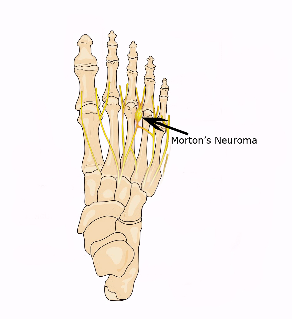 Home - Neuroma Treatment Center of NYC
