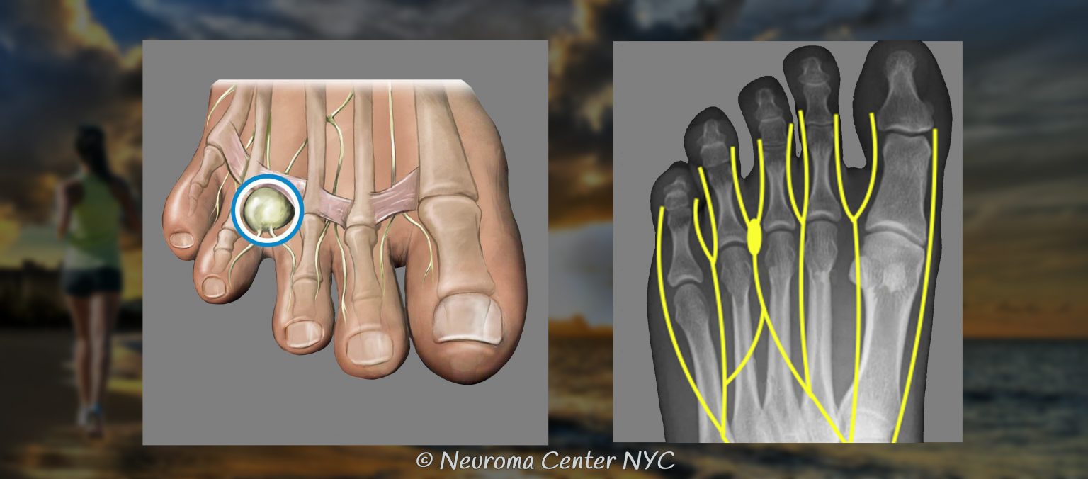 All about neuromas - Neuroma Treatment Center of NYC